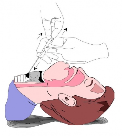 Cricothyrotomy Needle - Protocopedia