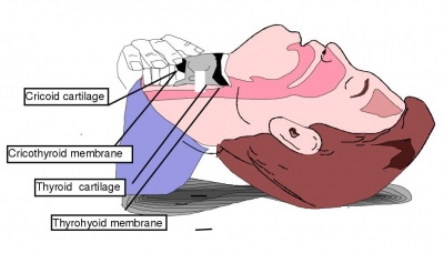 Cricothyrotomy Needle - Protocopedia