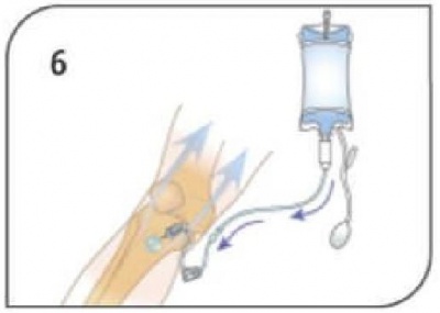Intraosseous Infusion - Femoral - Protocopedia